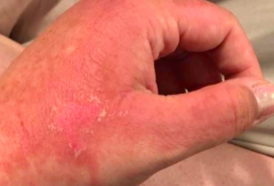 Parents warn others after little girl is covered in blisters caused by ...